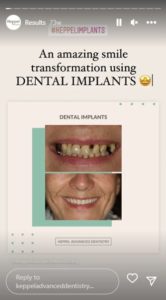 Top 15 Instagram story ideas for Dental Service